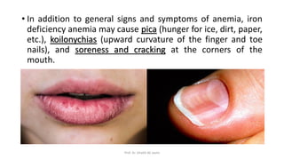 iron deficiency Anemia and treatment .pdf