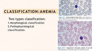 anemia. a physiological appraisal pptx | PPTX