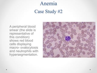 Iron Deficiency Anemia Slide