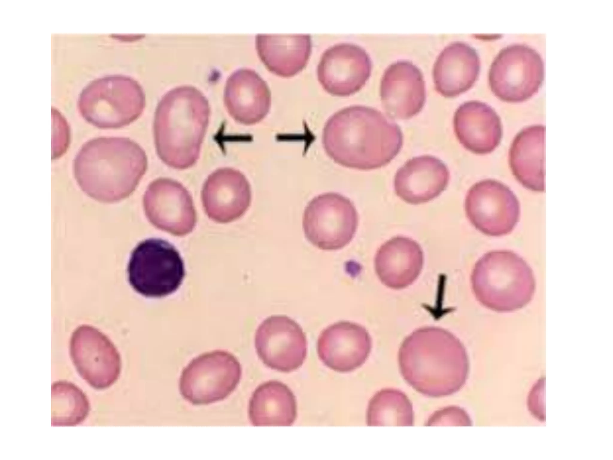 Anemia classification, cf, lab diagnosis | PPT