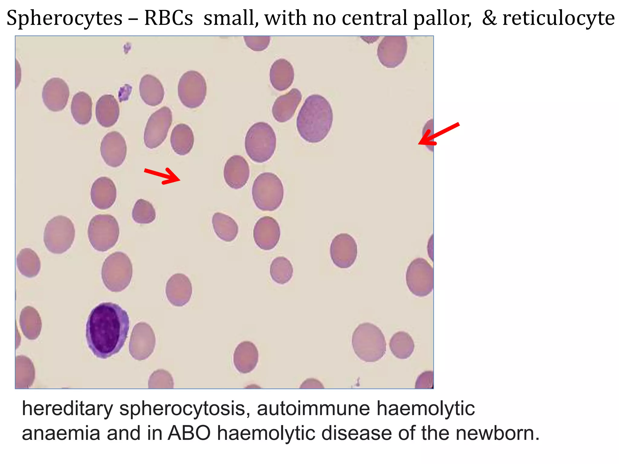 Anemia classification, cf, lab diagnosis | PPT