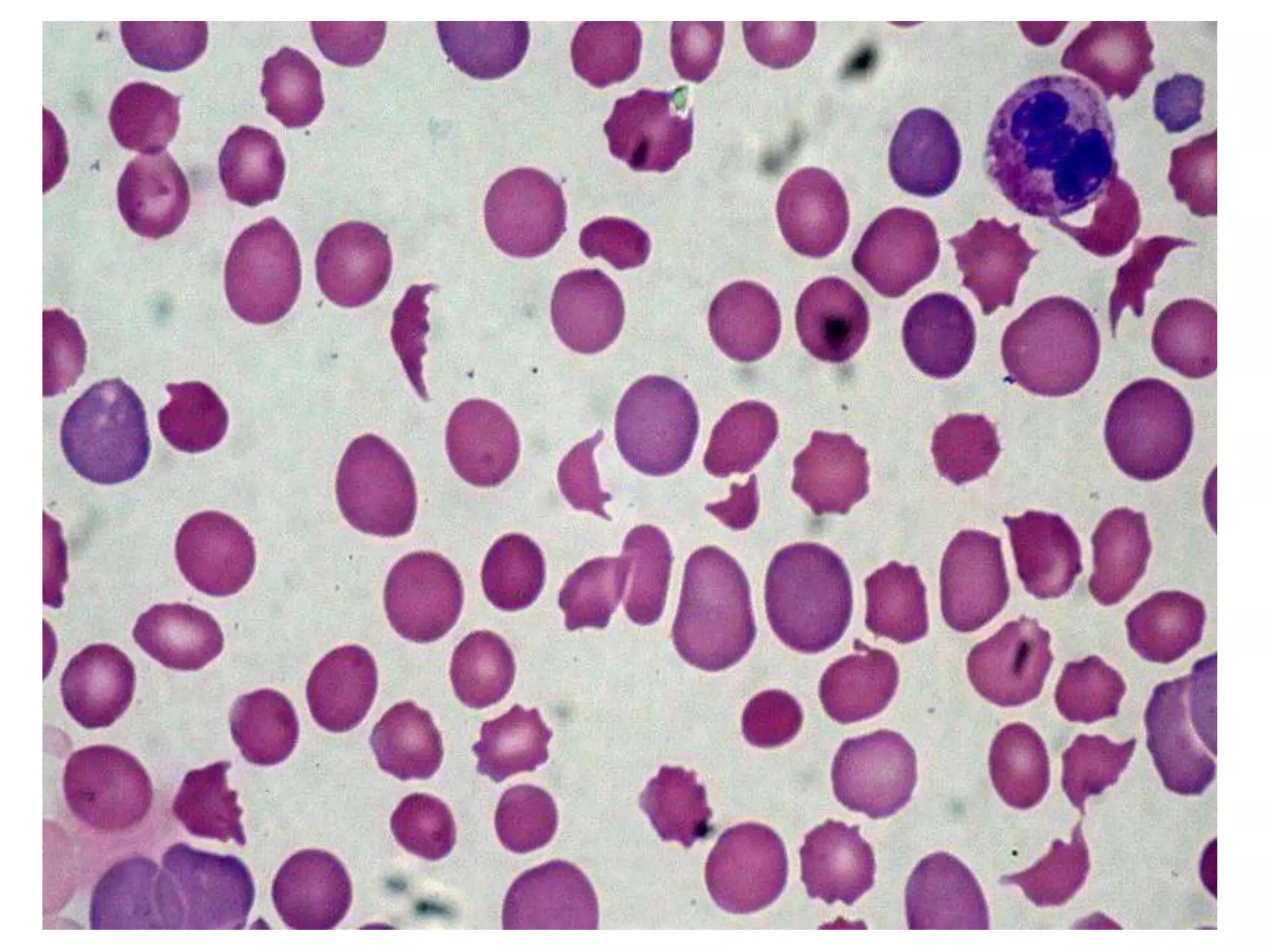 Anemia classification, cf, lab diagnosis | PPT