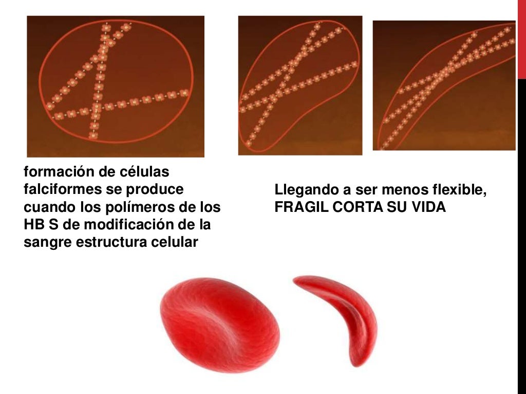 Anemia de celulas falciformes