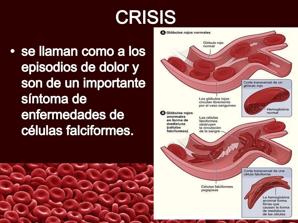 Anemia de celulas falciformes