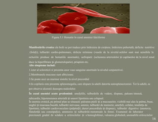 anemia falciporma - prezentare ppt si imagini | PPT