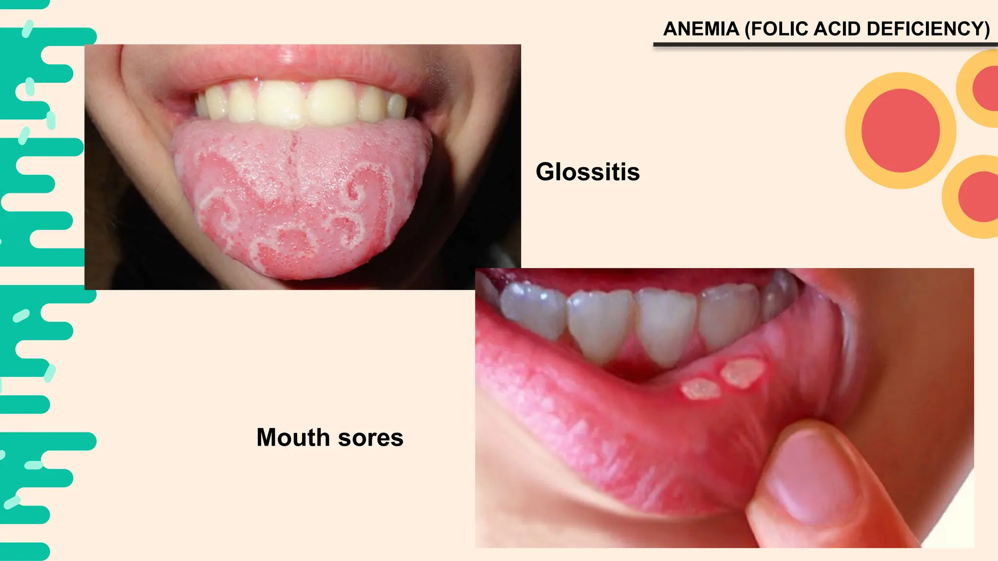 _ANEMIA-FOLIC-ACID-DEFICIENCY lack of rbc.pptx