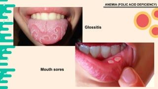 _ANEMIA-FOLIC-ACID-DEFICIENCY lack of rbc.pptx