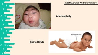 _ANEMIA-FOLIC-ACID-DEFICIENCY lack of rbc.pptx