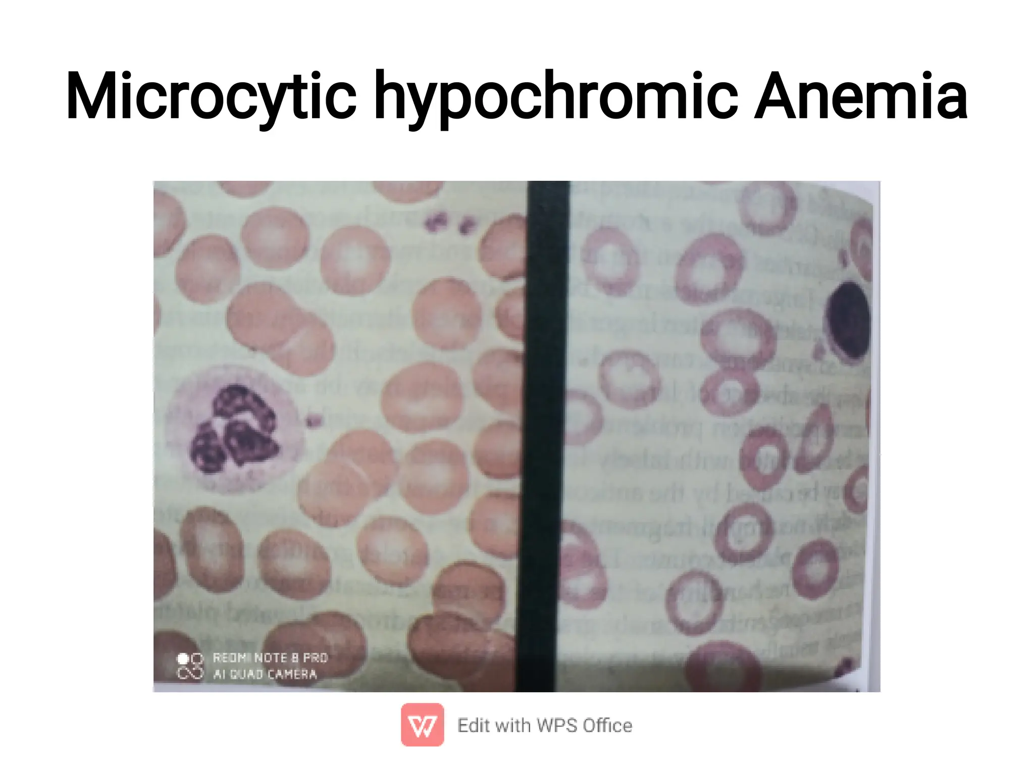 Classification of different types of anemia | PPT