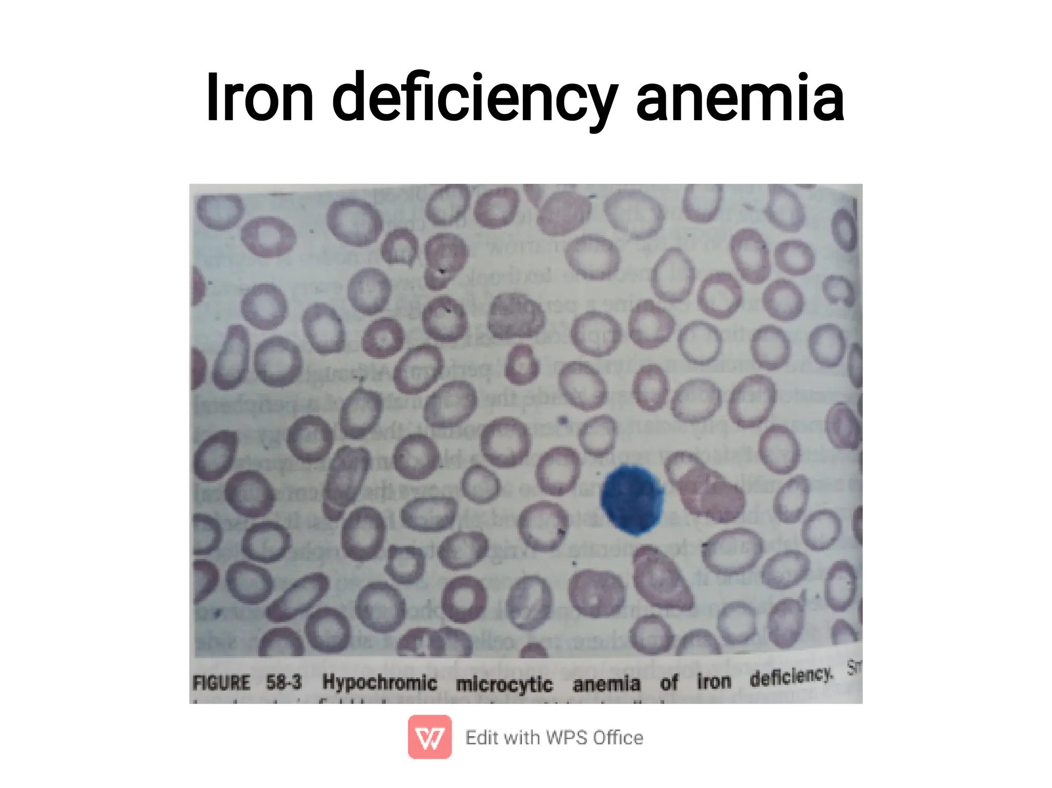 Classification of different types of anemia | PPT | Free Download