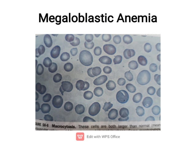 Classification of different types of anemia | PPT | Free Download