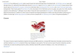 Anemia - Wikipedia.pdf