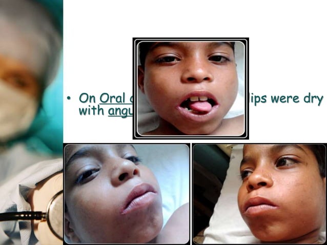 Anemia Case Presentation | PPTX