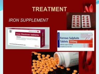 Iron deficiency anemia | PPTX