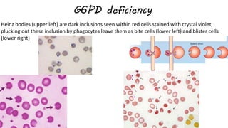 pathology of Anemia | PPT