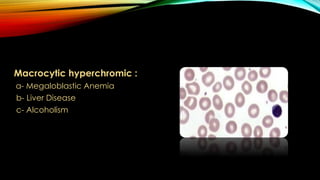 Anemia | PPT