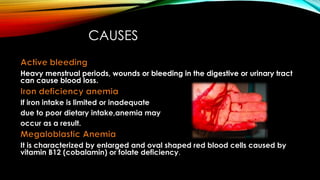 Anemia | PPT
