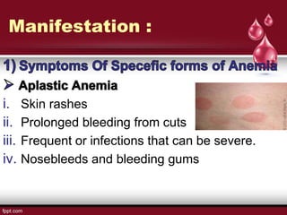 Anemia | PPTX