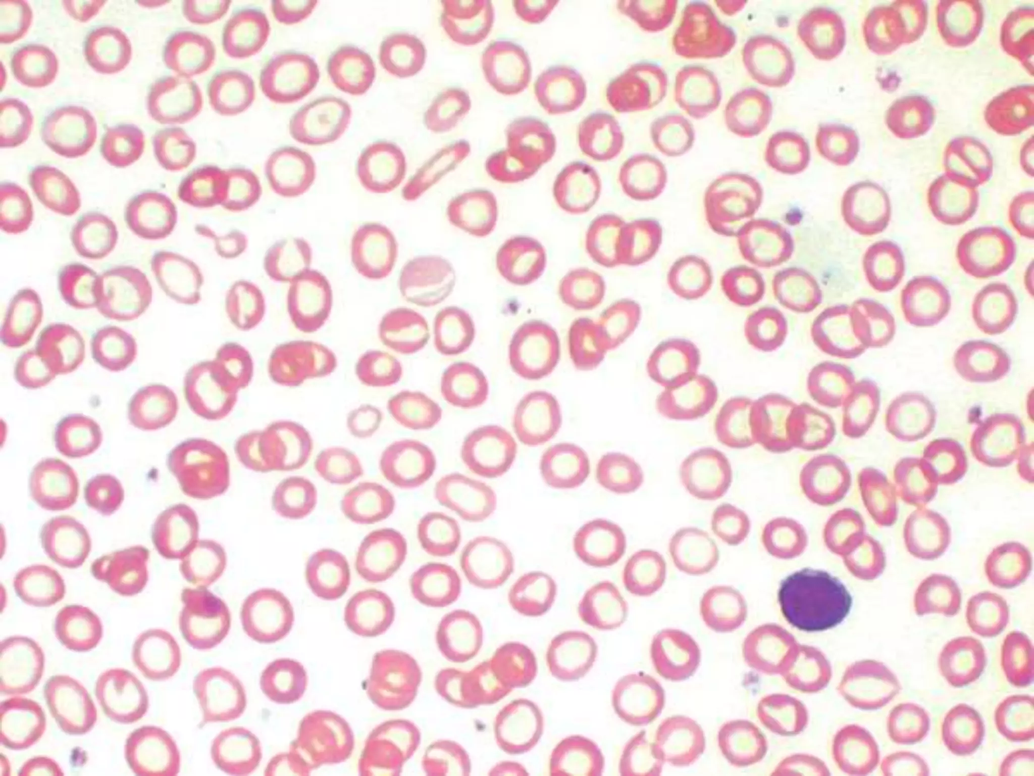 Anemia and its classification | PPTX