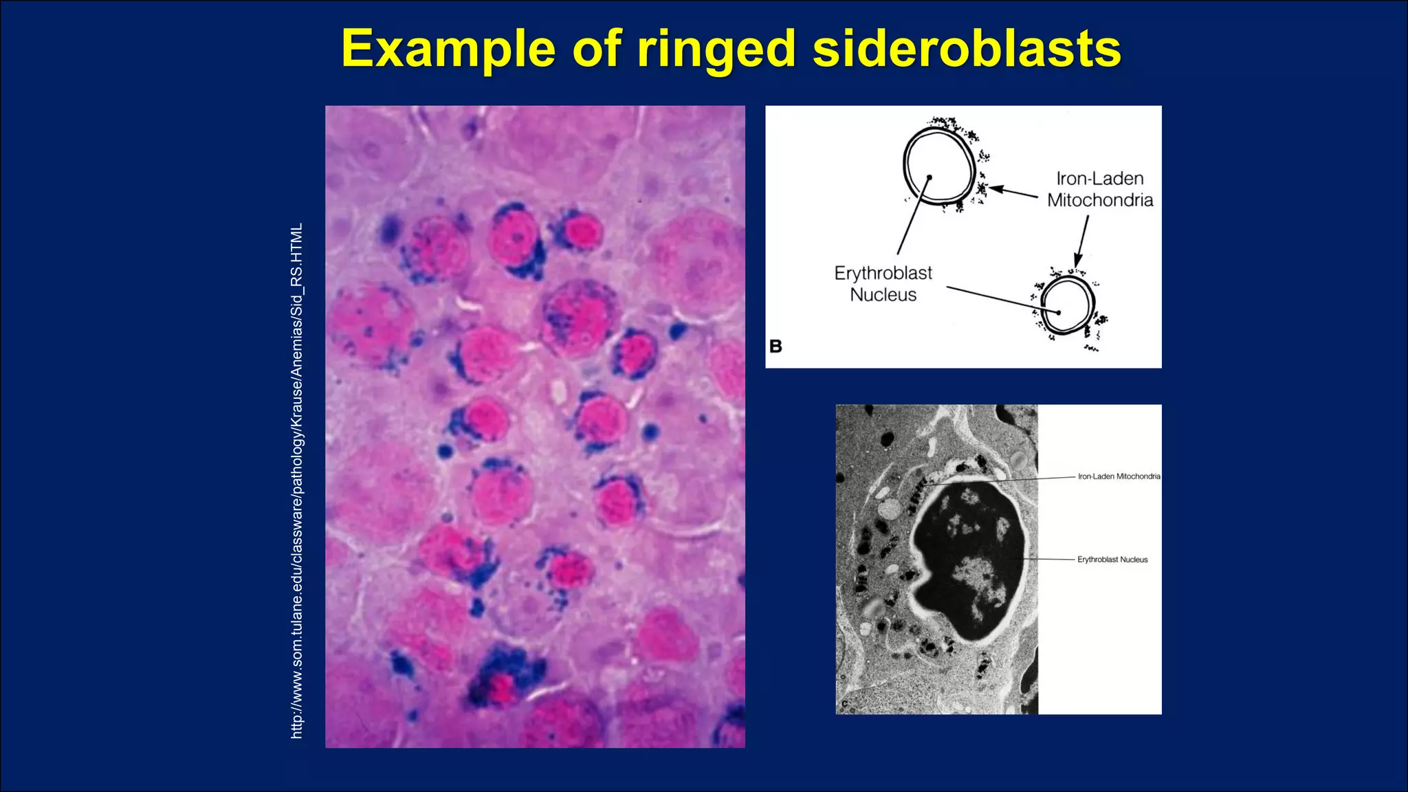 anemia clasification.pdf