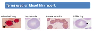 Anemia Classification and Investigation Tests.pdf | Blood Disorders ...
