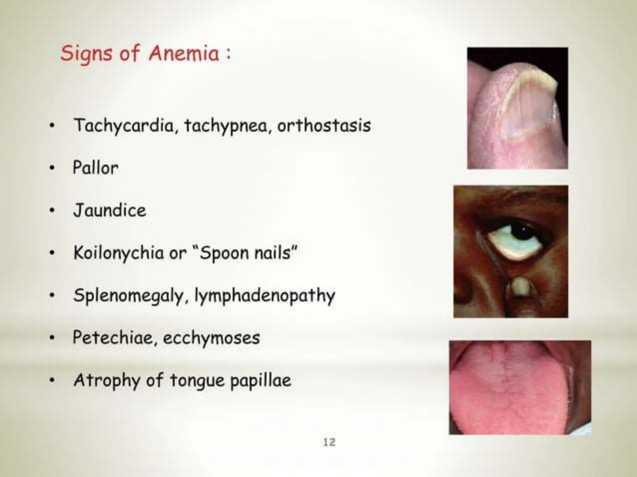 Anemia Clinical Manifestations .pptx clinical features of Anaemia.ppt