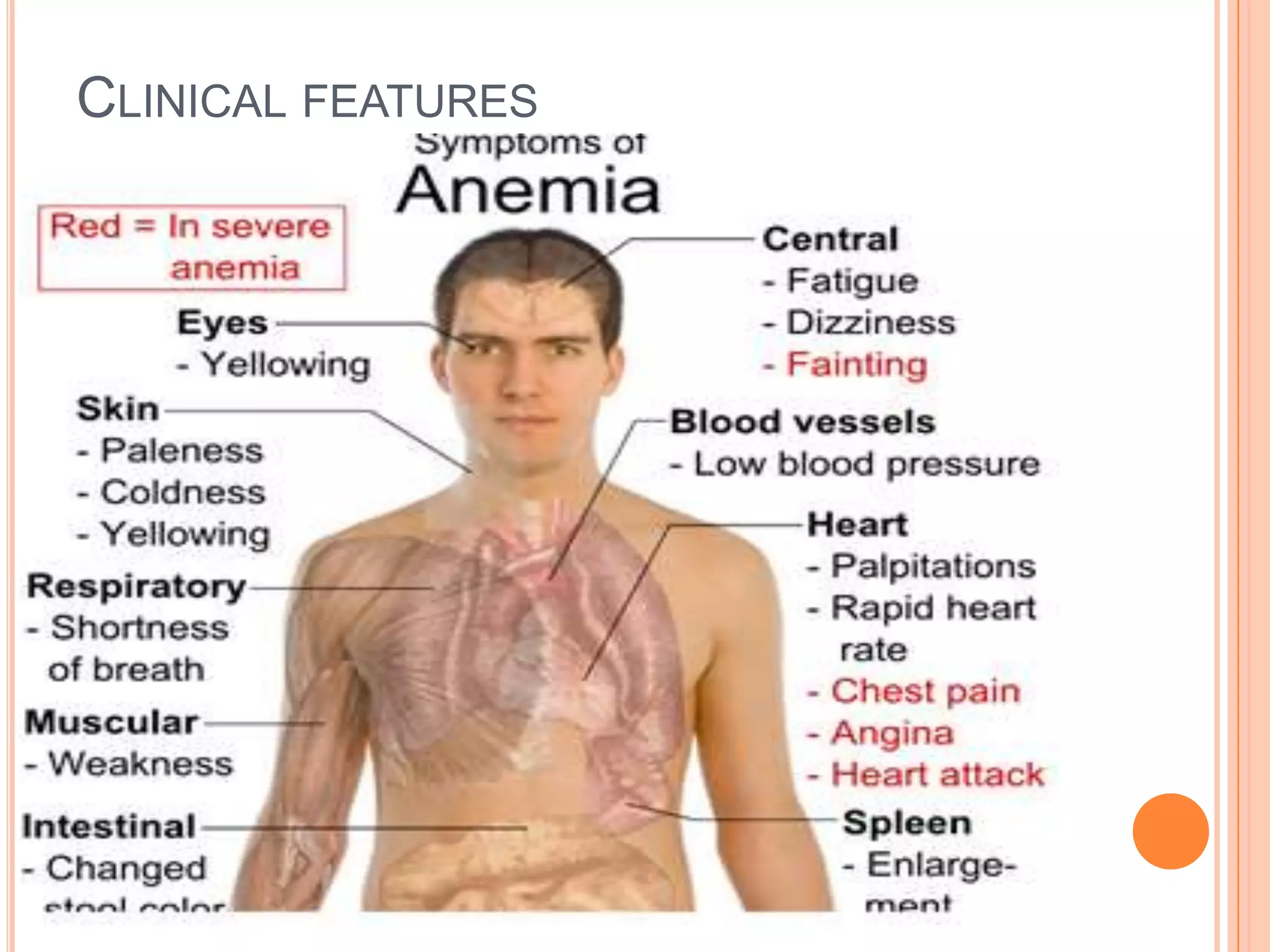 Anemia complication | PPTX