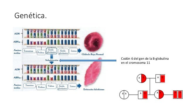 Anemia de células falciforme