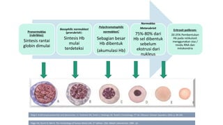 Anemia Defisiensi Folat dan B12.pptx