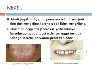 Anemia difiensi besi, polisitemia, dan leukimia.pptx