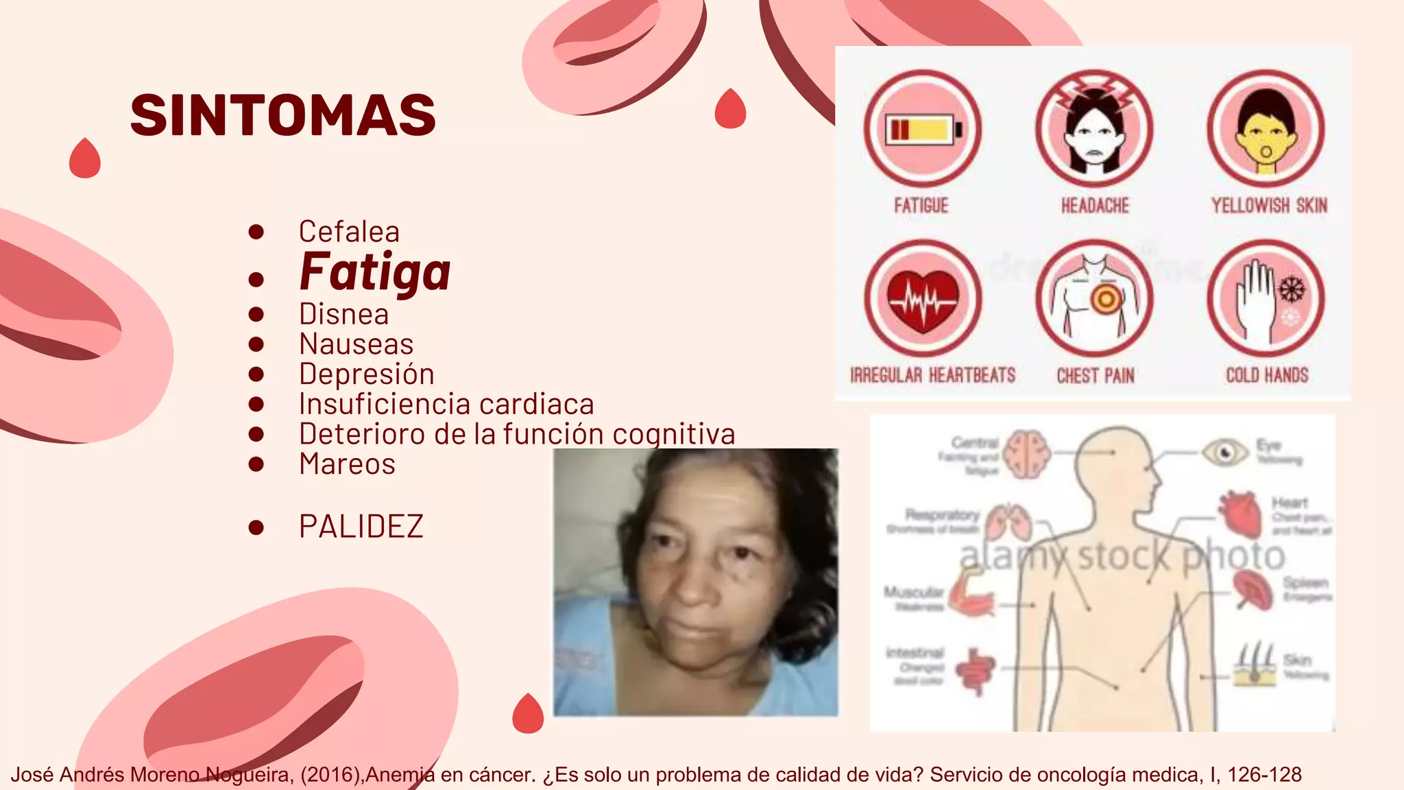 Anemia en paciente con cancer y anemia de la inflamacion cronica.pptx
