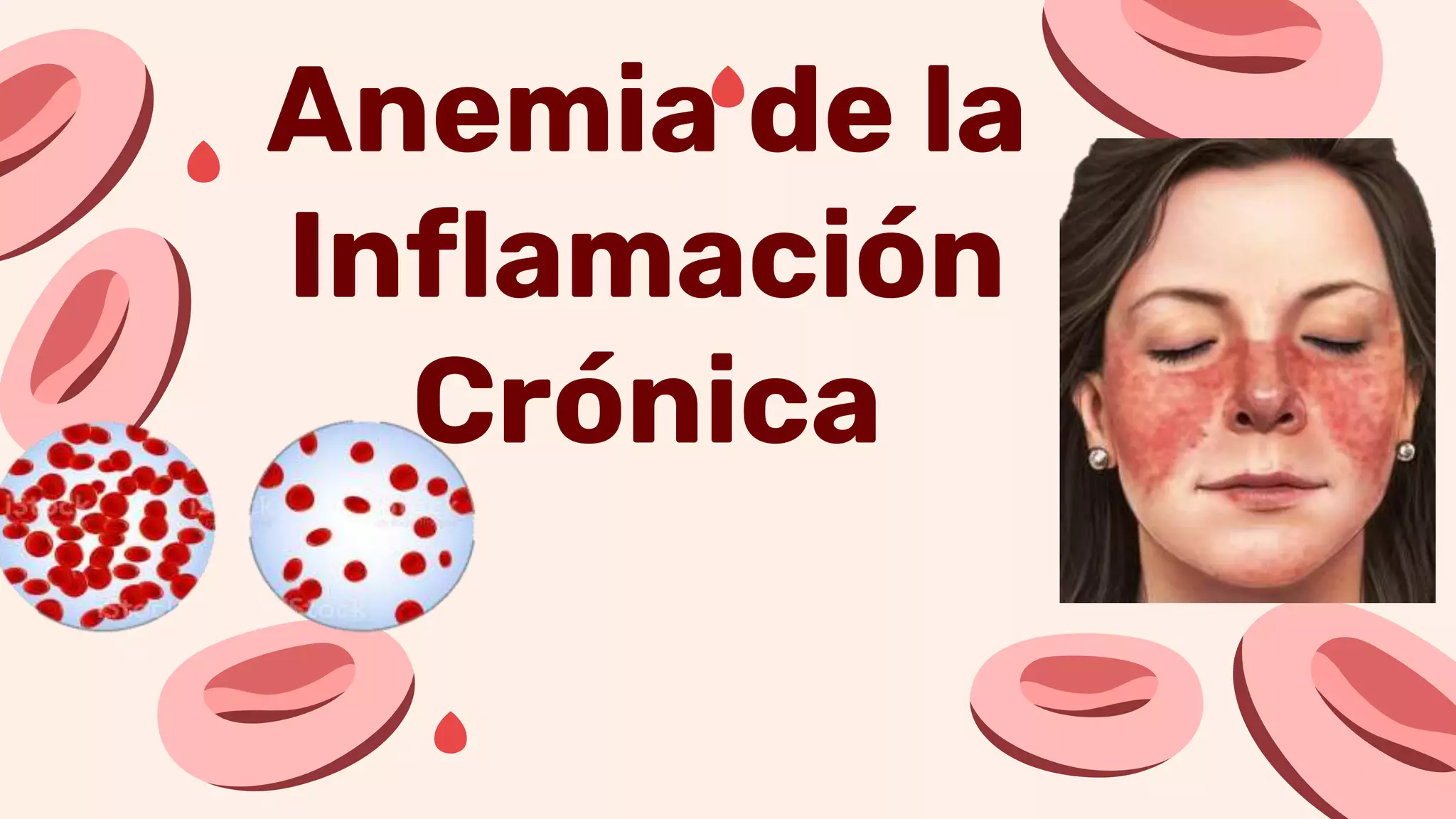 Anemia en paciente con cancer y anemia de la inflamacion cronica.pptx