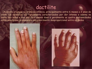 Anemia falciforme | PPT