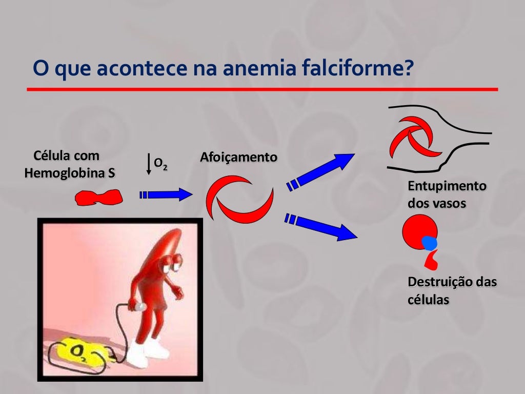 Anemia Falciforme