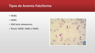 Anemia Falciforme (1).pdf