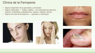 Anemia ferropénica | PPTX