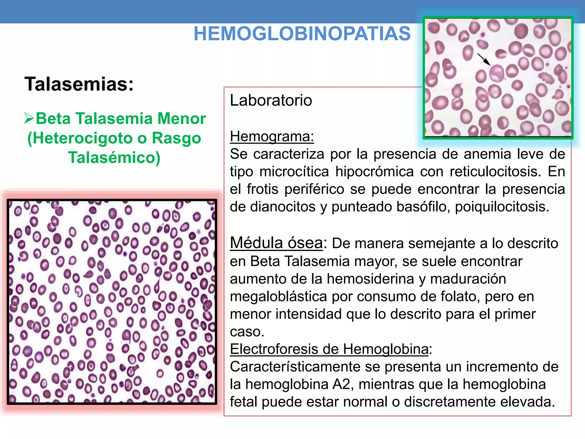 Anemia Hemolitica | PPTX