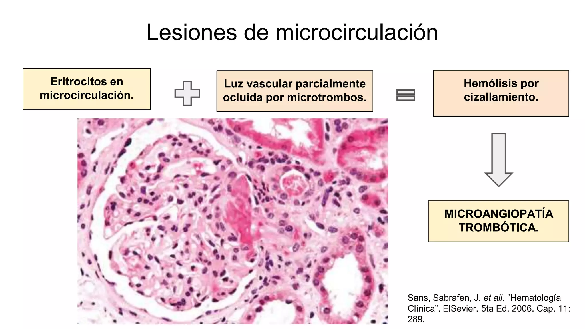 Anemia hemolítica microangiopática | PPTX