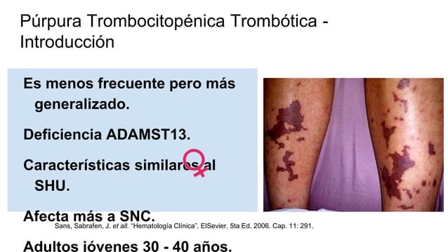 Anemia hemolítica microangiopática | PPTX
