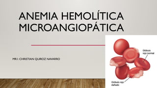 anemia hemoltica microangioptica. exposi | PPTX