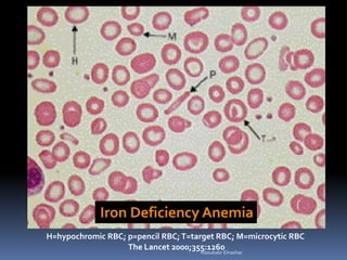 Iron deficiency anaemia in pregnancy | PDF