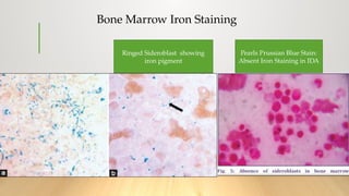 iron deficiency and megaloblastic anemia | PPTX