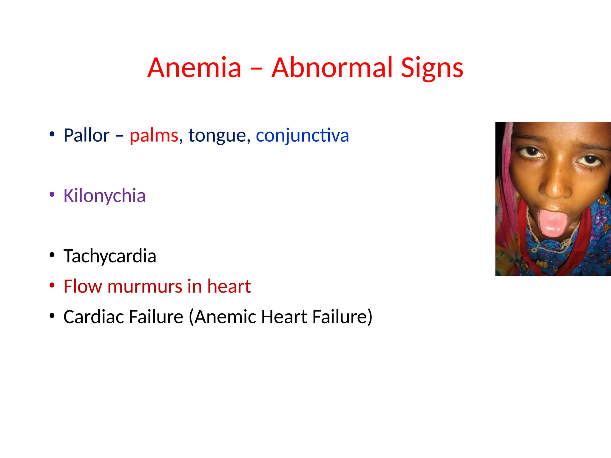 anemia in children ppt presentation paediatrics | PPTX
