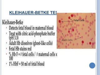Anemia in newborn pediatrics.pptx