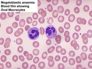 Anemia in pregnancy by oouth unit d medical students o&g | PPT