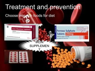 Anemia (iron deficiency anemia) | PDF