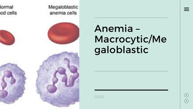 Anemia Macrocytic Megaloblastic
