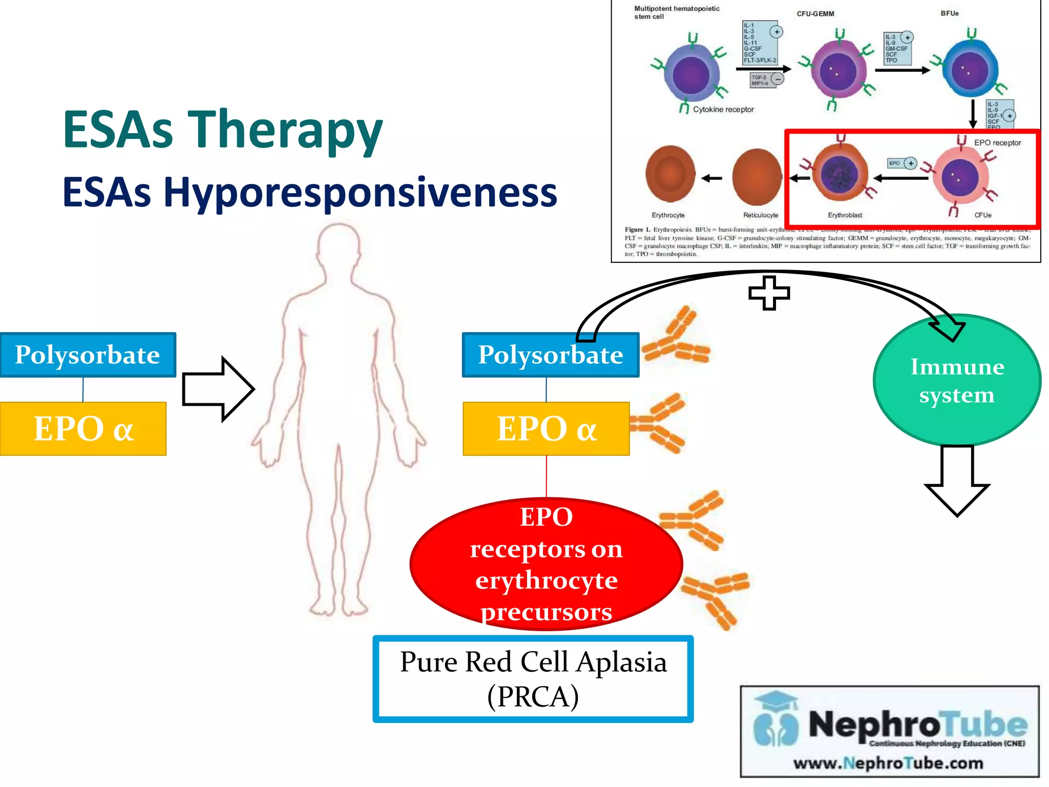 Anemia management in CKD (ESA Therapy) - Dr. Gawad | PPT