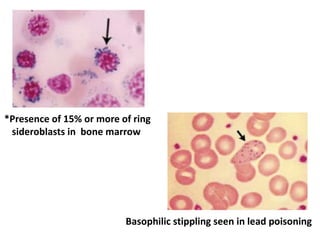 Ringed Sideroblasts Vs Basophilic Stippling