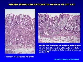 Anemia megaloblastica | PPT